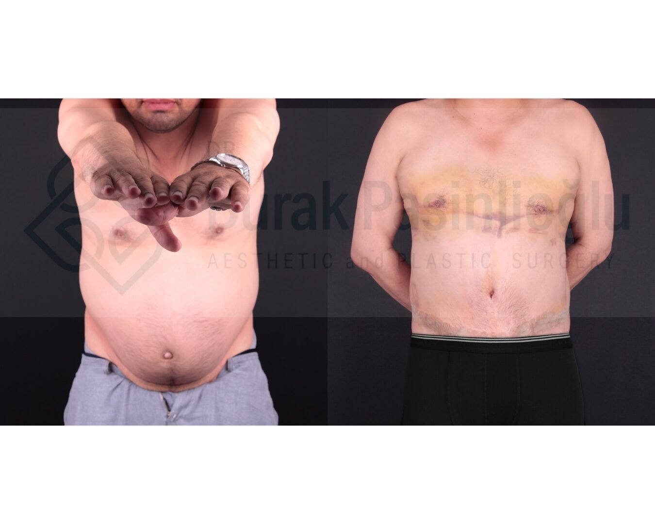Gynecomastia (Male Breast Reduction) in Turkey | Hello Skin Clinic